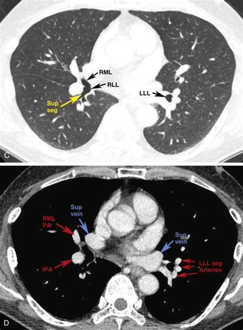 The Pulmonary Hila Radiology Key
