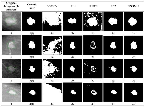 Mathematics Free Full Text Breast Abnormality Boundary Extraction In Mammography Image Using