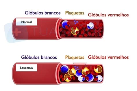 Sintomas Tratamento E Cura Da Leucemia Mielóide Aguda Tua Saúde