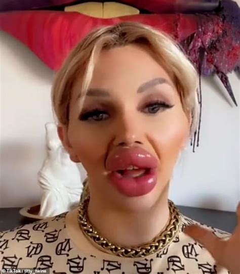 Dostala Som Toľko Výplní Do Pier že Sa Mi ťažko Dýcha A ústa Sa Mi