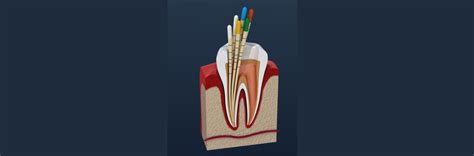 Root Canal Treatment Endodontic Success Dental Clinic
