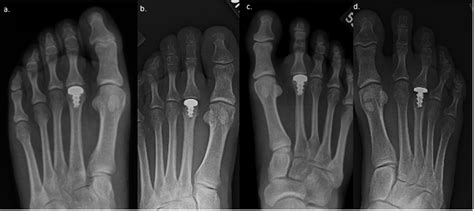 Lesser Metatarsophalangeal Joint Implant Hemiarthroplasty A Case