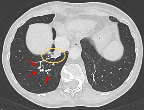 Yellow Nail Syndrome A Case Report