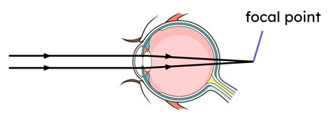 Lesson Common Defects Of The Human Eye Oak National Academy