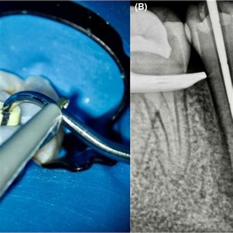 A A Stainless Steel Endodontic Plugger Attached To An Electronic Apex