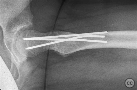 Scfe Longitudinal Images Over 6 Years 10 16years Old