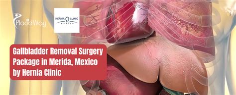 Hernia Clinic Gallbladder Removal Package In Merida Mexico