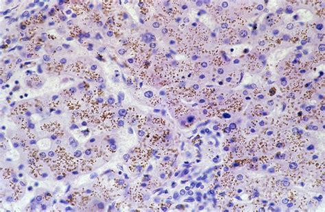 Liver In Haemosiderosis Photograph By Astrid And Hanns Frieder Michler
