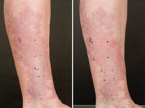 Lesion 5 Pre And Post Treatment Of Lower Leg Download Scientific