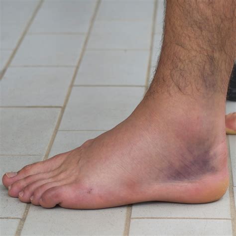 Ankle Sprain Recovery Physio Professionals