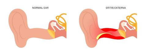 Premium Vector Swimmers Ear Otitis
