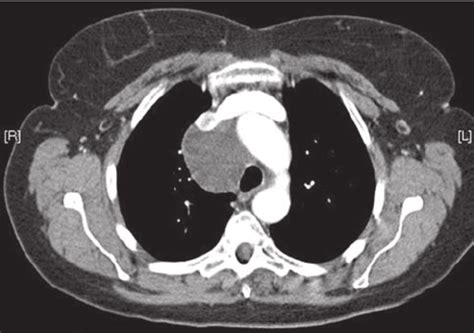 Chest Ct Scanning Image Of A Bronchogenic Cyst Extending To The Download Scientific Diagram