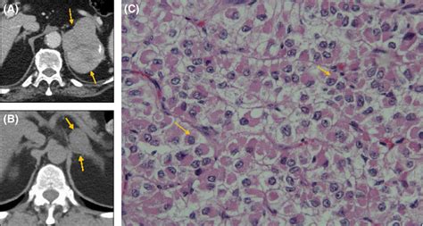 A Contrast Enhanced Abdominal Ct Scan Arrow Adrenal Nodule 2015