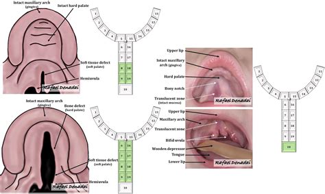 Submucous Cleft Palate
