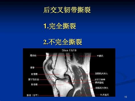 膝盖韧带断裂 图库 五毛网