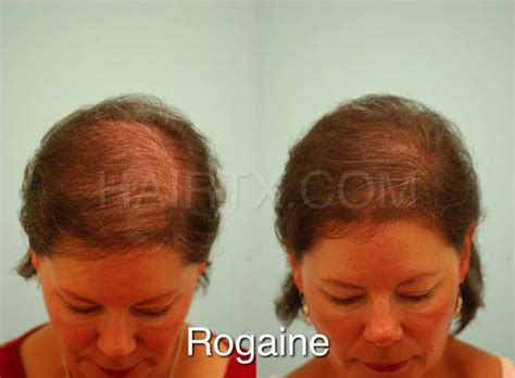 Slsilk How Long For Sulfatrim To Work Does Rogaine Cause Shedding Only Reserve Think