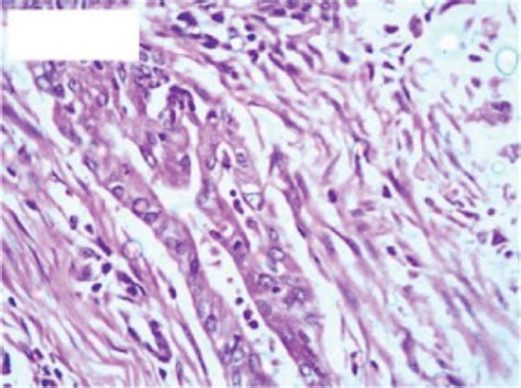 A Tall Columnar Cells In Mixed Type Carcinoma Hematoxylin Eosin