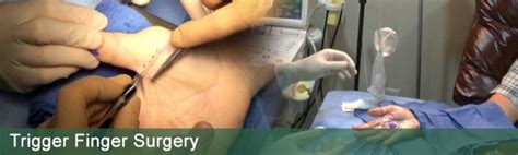 Why You Opt Trigger Finger Surgery In India