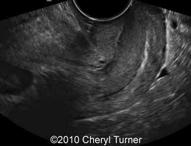 Autoamputation Of Cervical Polyp Presenting As Spontaneous Miscarriage