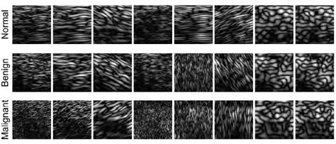 Figure 1 From A Novel Algorithm For Breast Lesion Detection Using Textons And Local