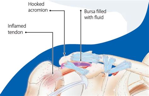 Shoulder Impingement
