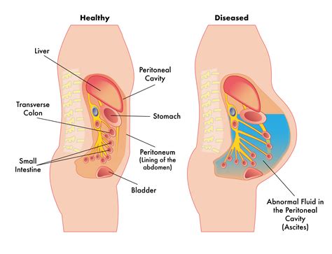Standardization Of Bedside Paracentesis Shm Abstracts Society Of