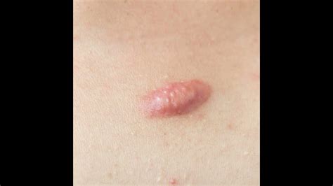 켈로이드 흉터가 있어서 고민될때 Youtube