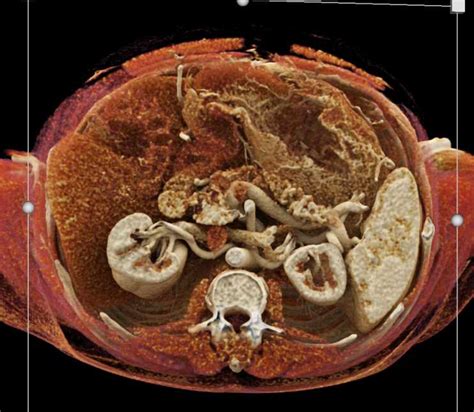 Pancreatic Cancer With Dilated Pancreatic Duct And Incidental Gist