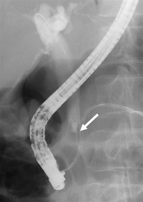 Ercp Revealed Irregular Stricture Of The Distal Cbd Arrow Brush
