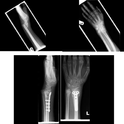 Intraoperative Fluoroscopy Left Wrist Post Repair Download Scientific Diagram