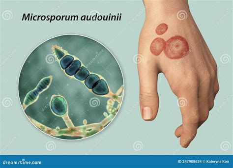 Hand Fungal Infection Tinea Manuum 3d Illustration Cartoondealer