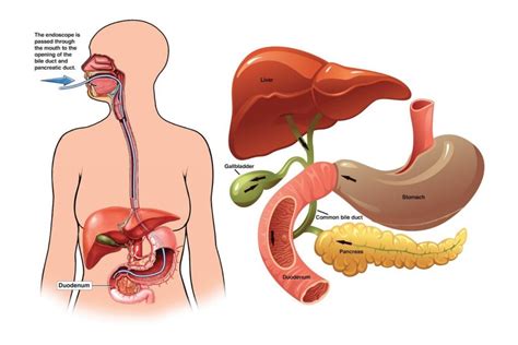 Endoscopic Retrograde Cholangiopancreatography Ercp Procedure