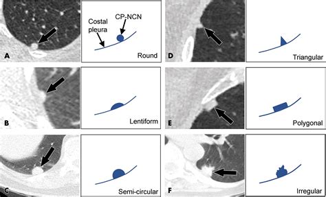 How I Do It Management Of Pleural Attached Pulmonary Nodules In Low Dose Ct Screening For Lung