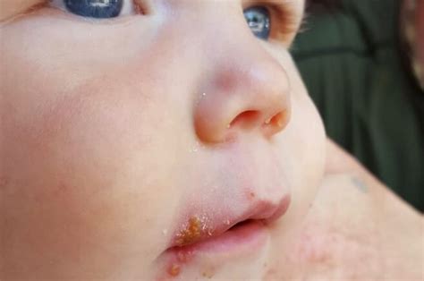 Mengenal Impetigo Penyakit Kulit Menular Pada Anak Nakita