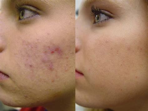 remédios naturais para eliminar a acne Dicas de Beleza