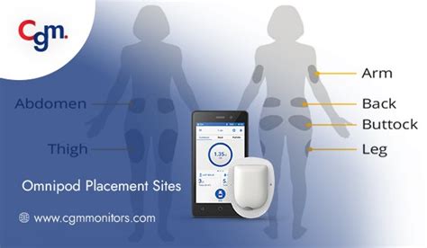 Omnipod Placement Sites Right Body Location To Wear It