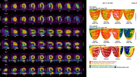 Pet Guided Strategy Lowers Risk Boosts Outcomes In Stable Cad Century Pet Guided Strategy Lowers Risk Boosts Outcomes In Stable Cad Century