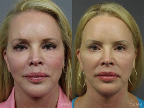 Liquid Facelift Before After Gallery Patient