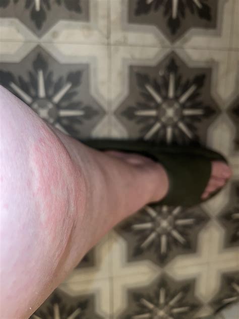 Is This A Lamotrigine Rash Rlamotrigine