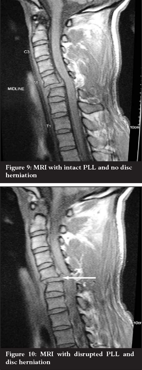 Figure 9 From Management Of Unilateral Cervical Facet Dislocations A