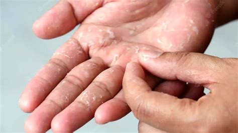 پوسته پوسته شدن کف دست، علامتی از کمبود این ویتامین ها