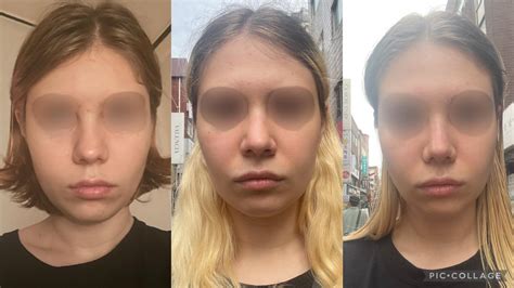 Revision Septorhinoplasty 3 Weeks Po Or Why You Shouldnt Choose Korea For A Nose Job R