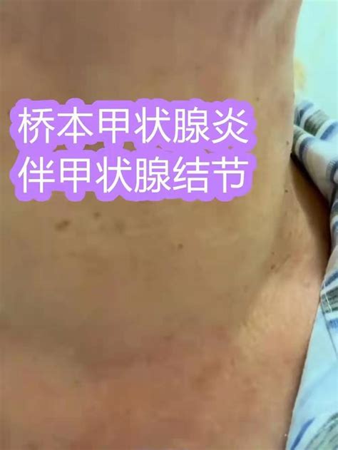 这样的“桥本氏甲状腺炎”千万别观察！ 知乎