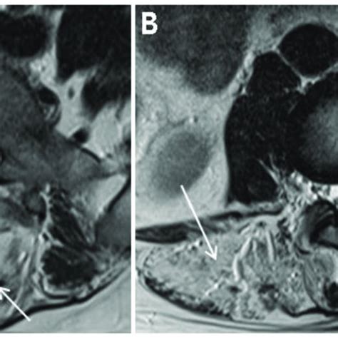 Magnetic Resonance Image Mri Of The Lumbar Spine A L5 S1 Disc