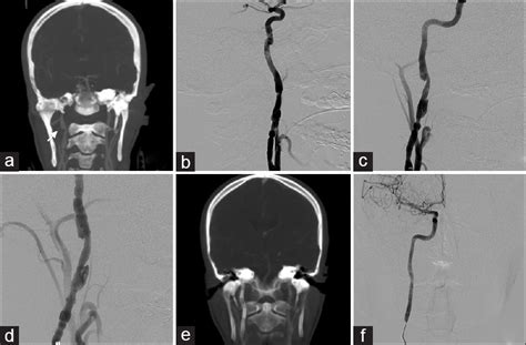 Pipeline Embolization Device As Primary Treatment For Cervical Internal