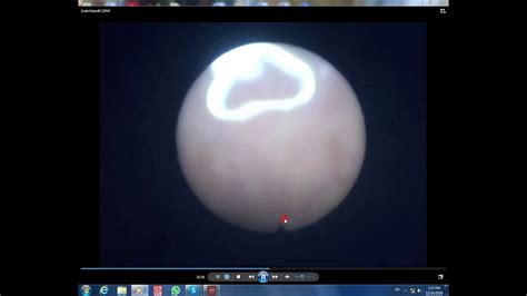 Nasoendoscopy Youtube
