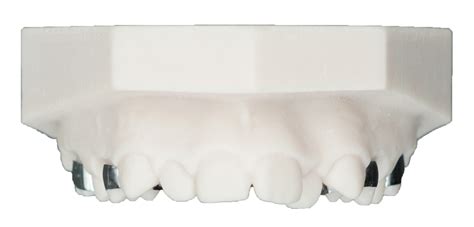 Palatal Expansion Archives Protec Dental