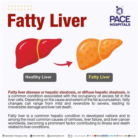 Fatty Liver Disease