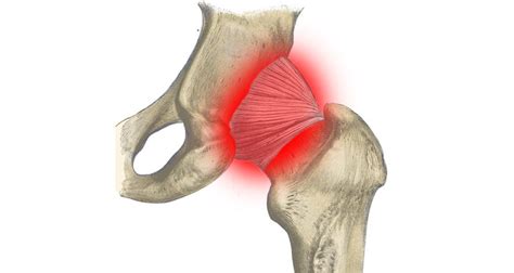 Hip Synovitis Symptoms Causes Treatment And Rehabilitation