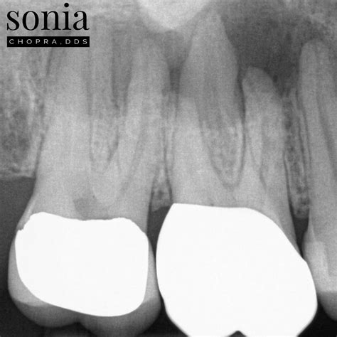 Why You Must Perform A Cold Test On Teeth Tooth Story